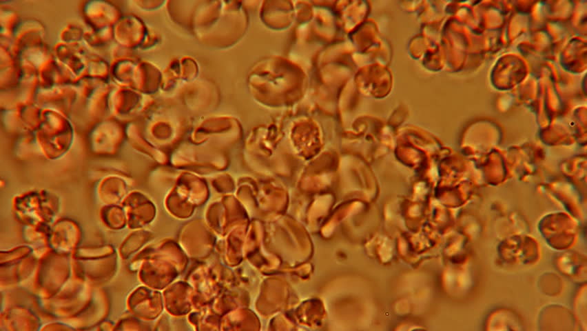 Blood Cell Channel 100x (HD 24p). Blood Platelets Seen Forming A Small ...
