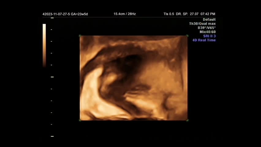 4D Ultrasound Ecography. Gynecological Medical Examination. 22 Weeks ...
