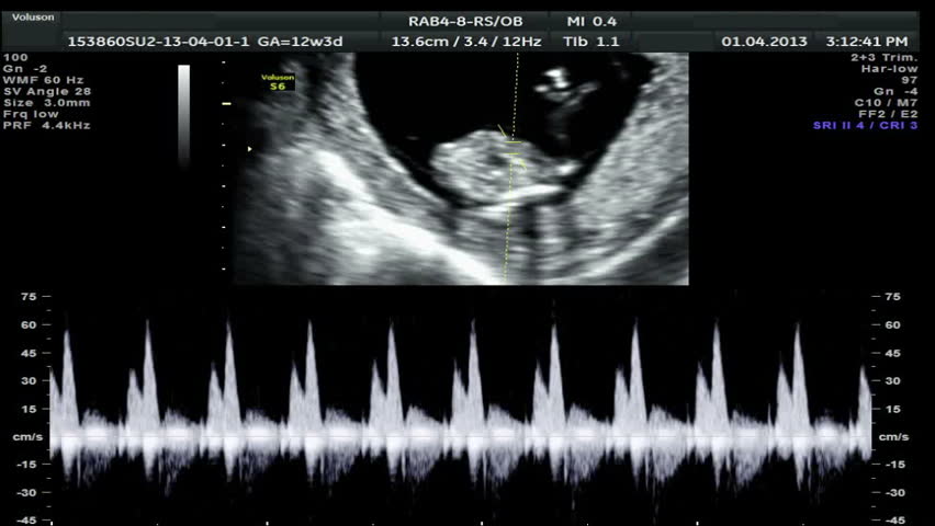 4D Ultrasound Ecography. Gynecological Medical Examination. 22 Weeks ...